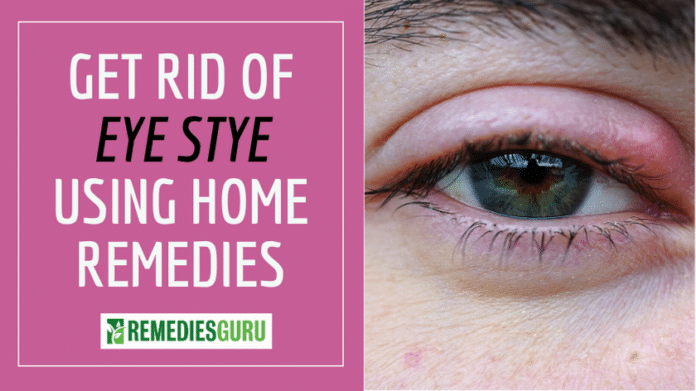 How to Get Rid of Eye Stye Using Home Remedies - Remedies Guru